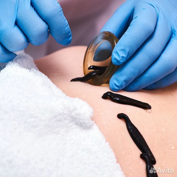 Пиявка лечебная