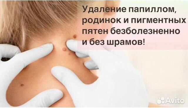Удаление,папиллом, родинок и пигментных пятен в Таганроге | Услуги | Авито