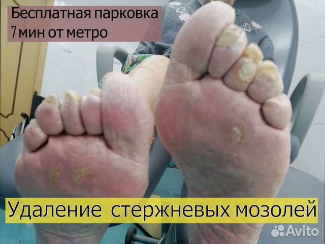 Стержневая мозоль / обработка / удаление в Москве | Услуги | Авито